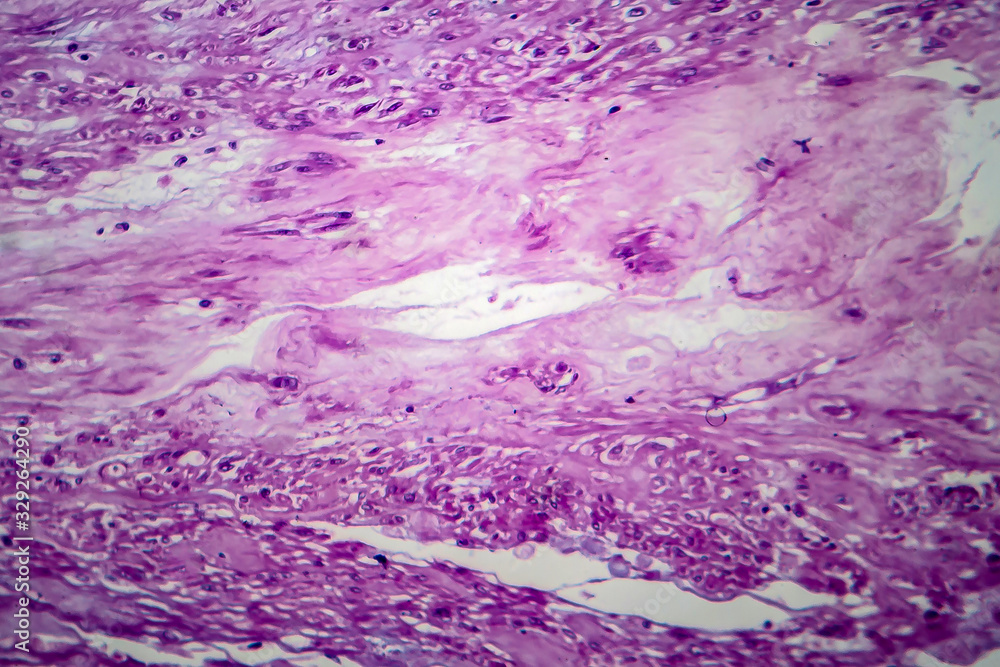 Uterine leiomyoma, also known as fibroids,a benign smooth muscle tumor ...