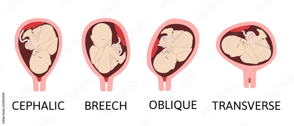 Different baby positions during pregnancy. Cephalic, Breech, transverse ...