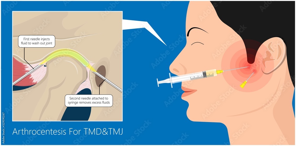 Temporomandibular Joint Disorders TMD TMJ treat pain displaced disc ...
