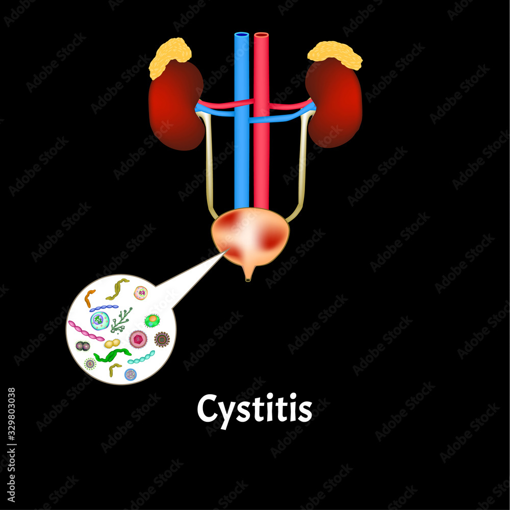 Cystitis. Inflammation of the bladder. The structure of the kidneys and ...