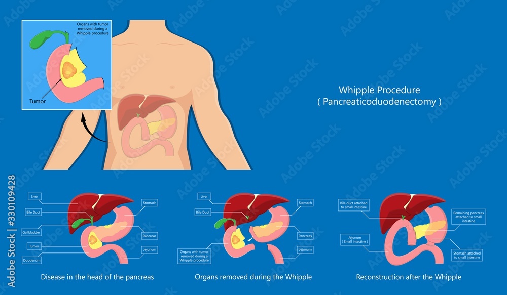 Whipple procedure pancreaticoduodenectomy Pancreatic cancer treatment total pancreatectomy Small ...