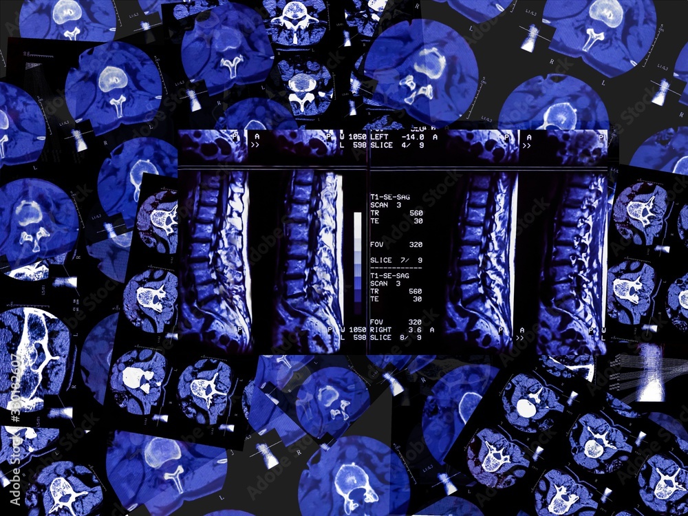 Magnetic resonance imaging of human spine of a patient with chronic ...