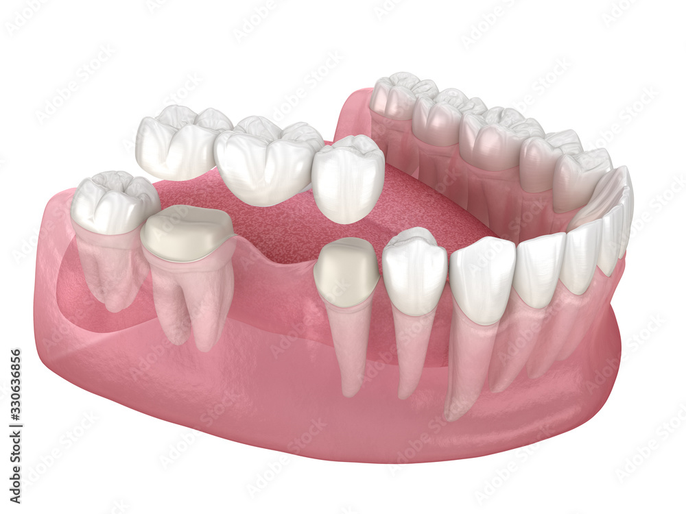 Dental bridge of 3 teeth over molar and premolar. Medically accurate 3D ...