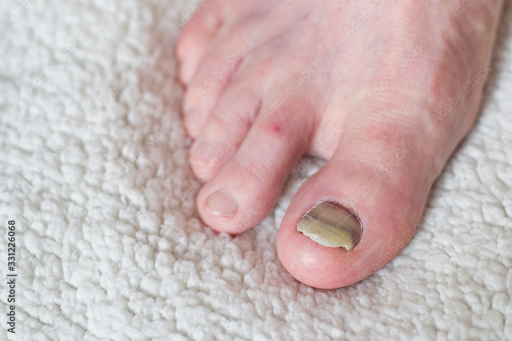 Nail injury Treatment of bruises and fractures. Damage to the nail ...