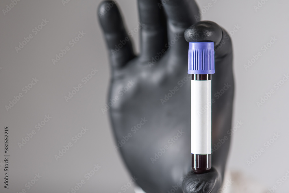 man's hand holding blood in a test tube close up, physical examination ...