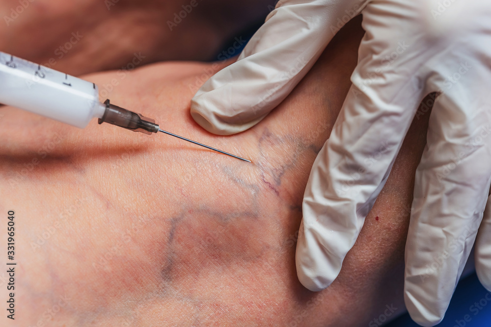 Injections into the veins of an elderly woman's leg close-up. Doctor's ...
