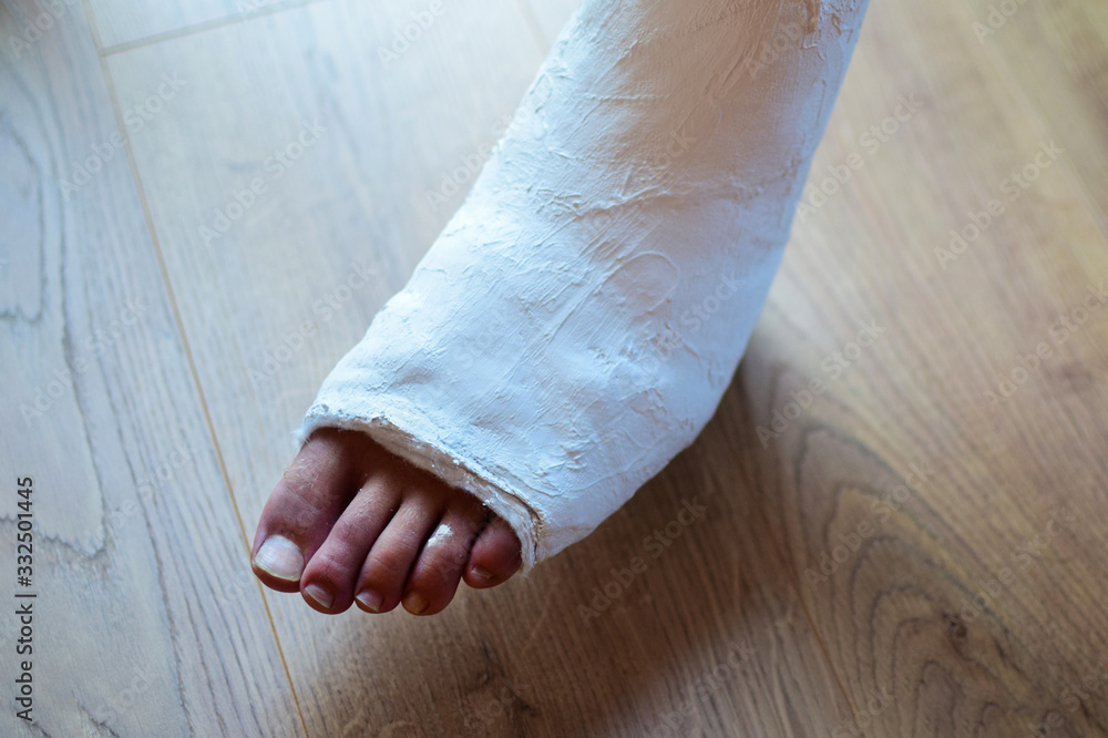 Fracture of the lower leg in a cast. Stock Photo | Adobe Stock