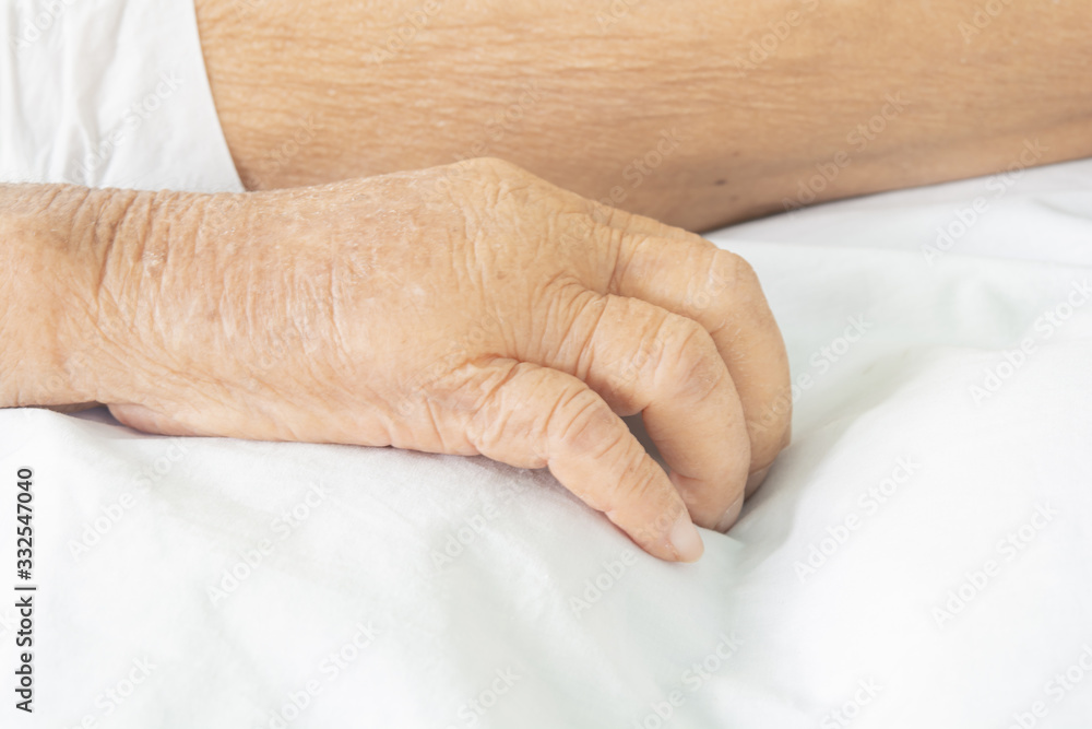 .Patient's hands and subcutaneous swelling. Chronic renal failure and ...