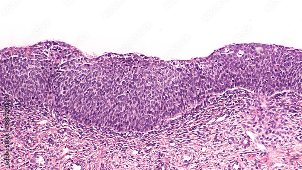 Severe Dysplasia (CIN IiI, HSIL), related to human papilloma virus (HPV ...