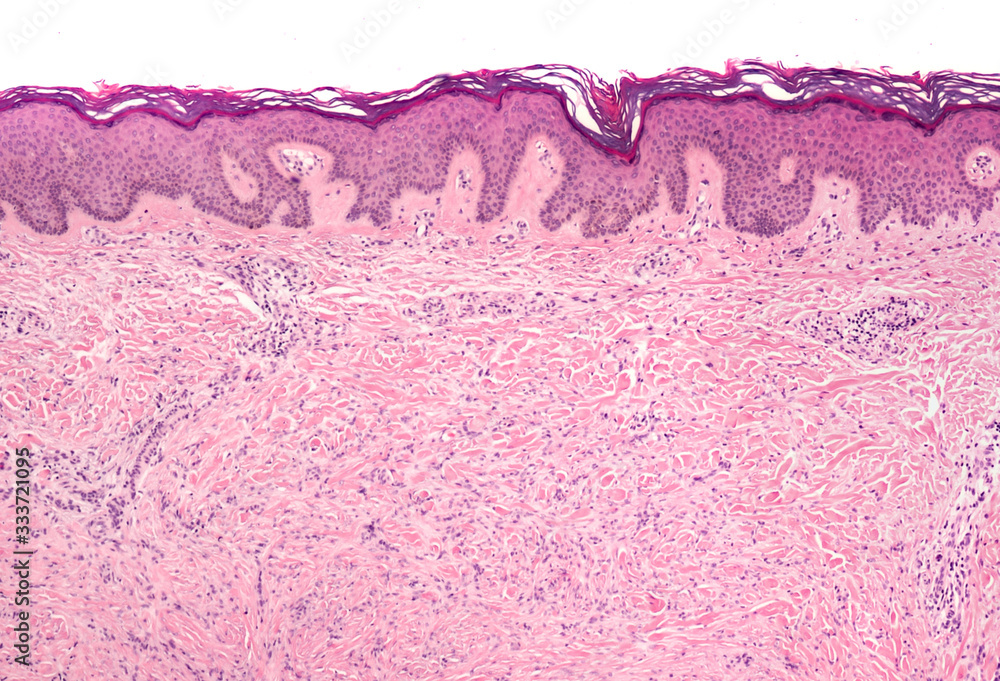 Tumors of Skin: Microscopic image (photomicrograph) of a dermatofibroma ...