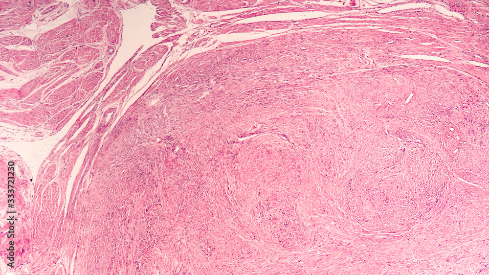 Micrograph of a leiomyoma, also known as "fibroid", a benign tumor ...