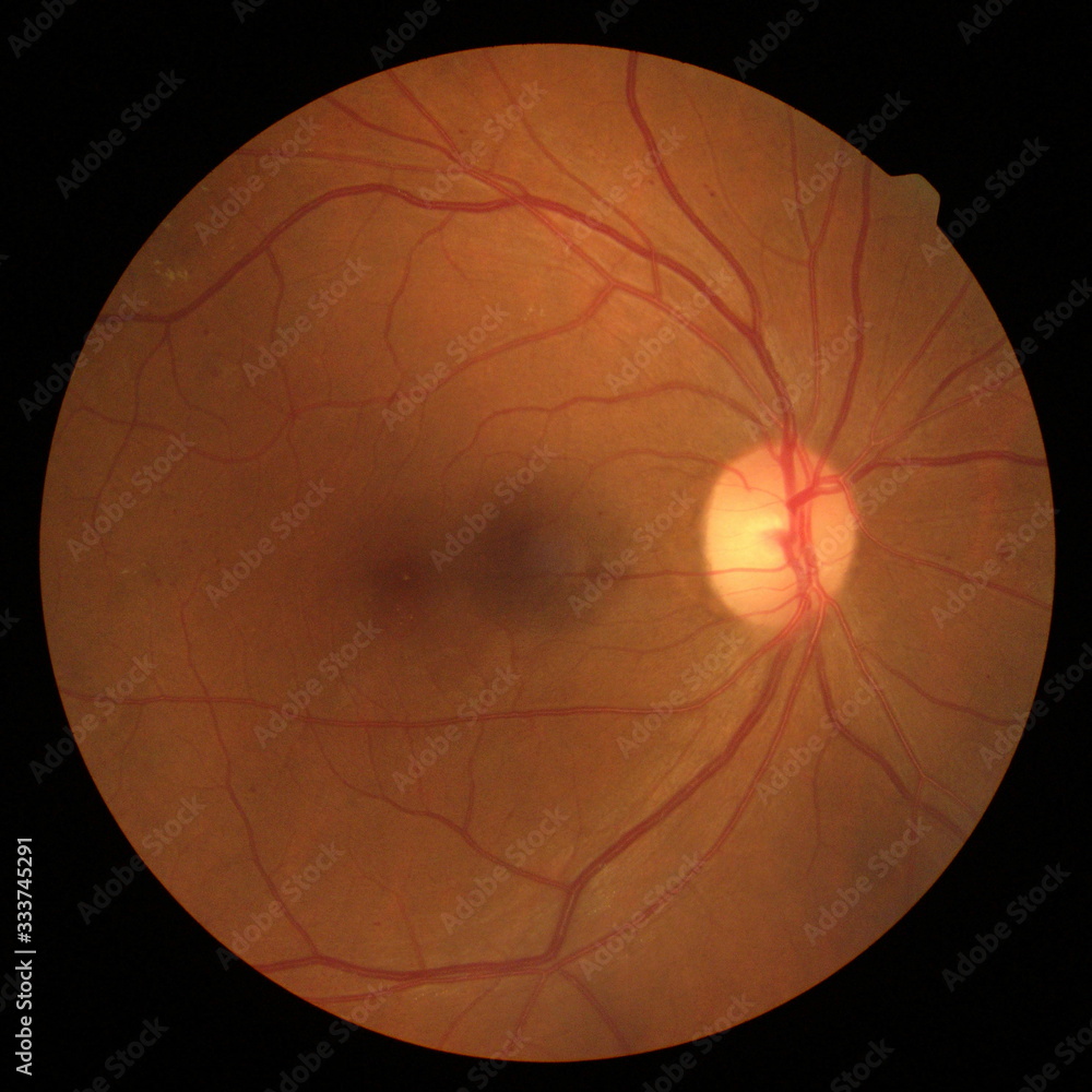 Retinal picture ,Medical photo tractional (eye screen) retinal ...