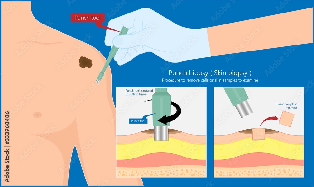 Стоковое векторное изображение «Skin biopsy dermoscope tool surgical ...