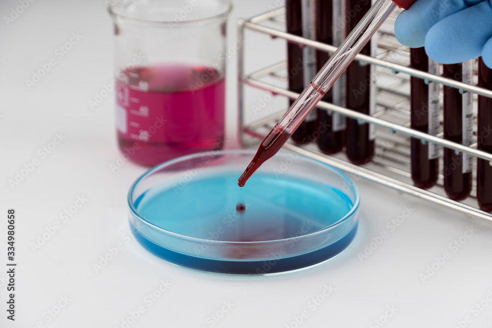 Methylene blue test liquid with blood sample for test, laboratory ...