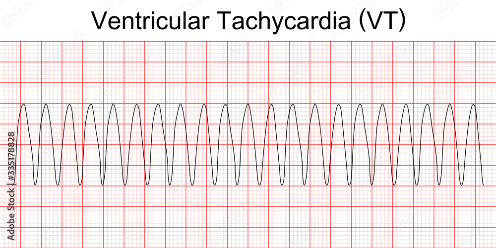 Electrocardiogram show monomorphic ventricular tachycardia (VT ...