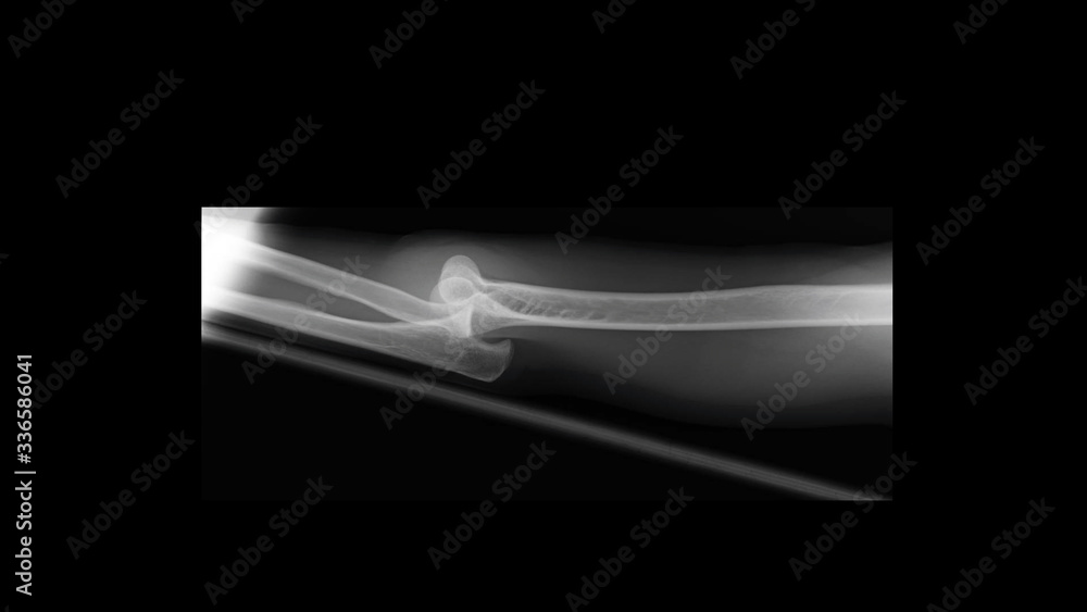 Film X ray elbow radiograph show elbow dislocation. Joint dislocation ...