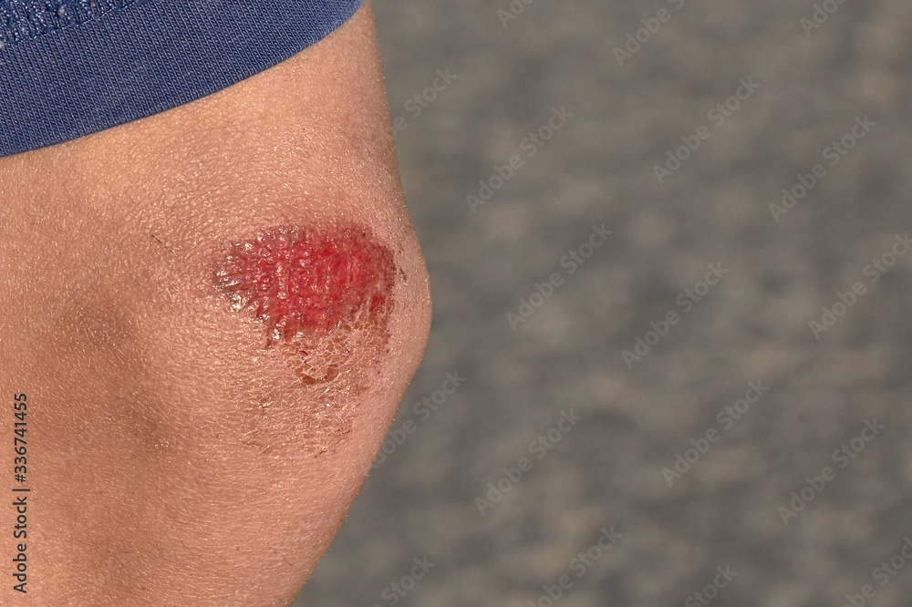 bruised wound on the knee, the boy fell and scratched his knee Stock ...