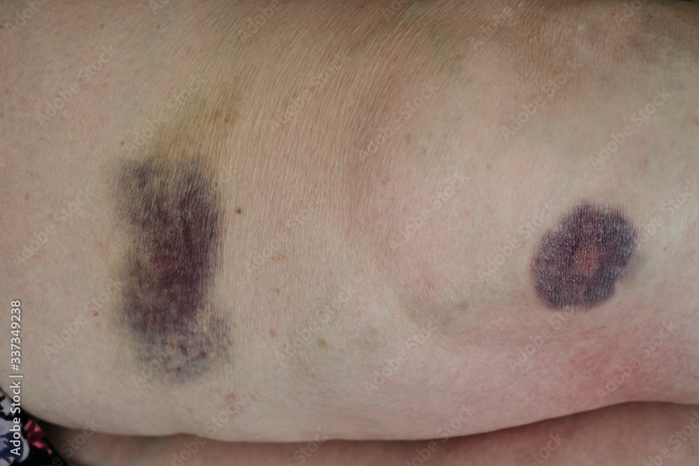 Two big bruises. Subcutaneous trauma on human skin, painful dark blue ...