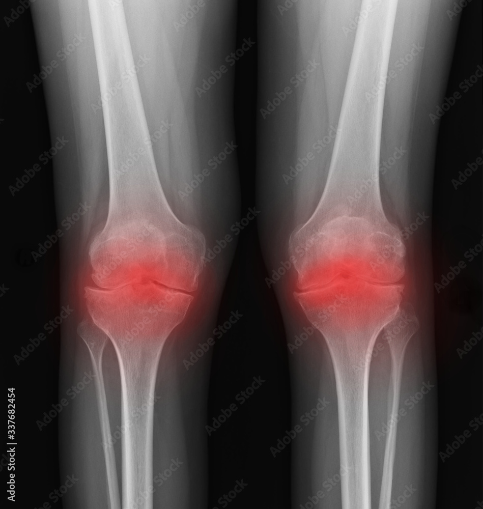 Foto de Stock Real skeleton x-ray of woman knee suffering from ...