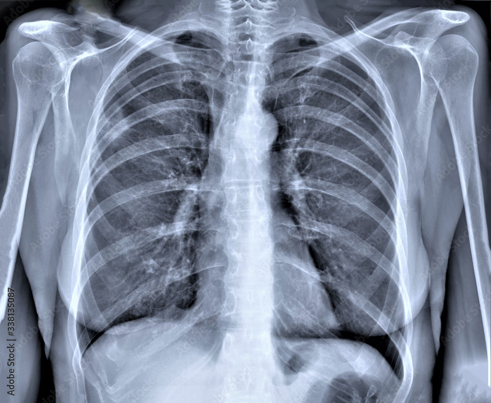 normal chest x-ray, diagnosis of pneumonia Stock Photo | Adobe Stock