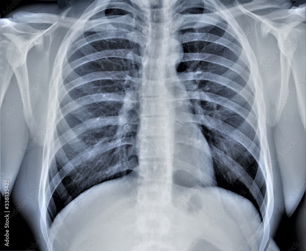 normal chest x-ray, diagnosis of pneumonia Stock Photo | Adobe Stock