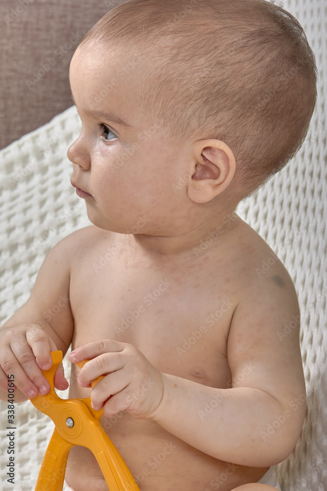 roseola rash a viral rash on the skin of a child Stock Photo | Adobe Stock