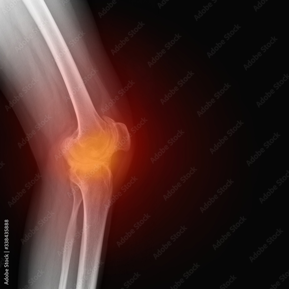 Real skeleton x-ray of woman knee suffering from rheumatism. Rheumatoid ...