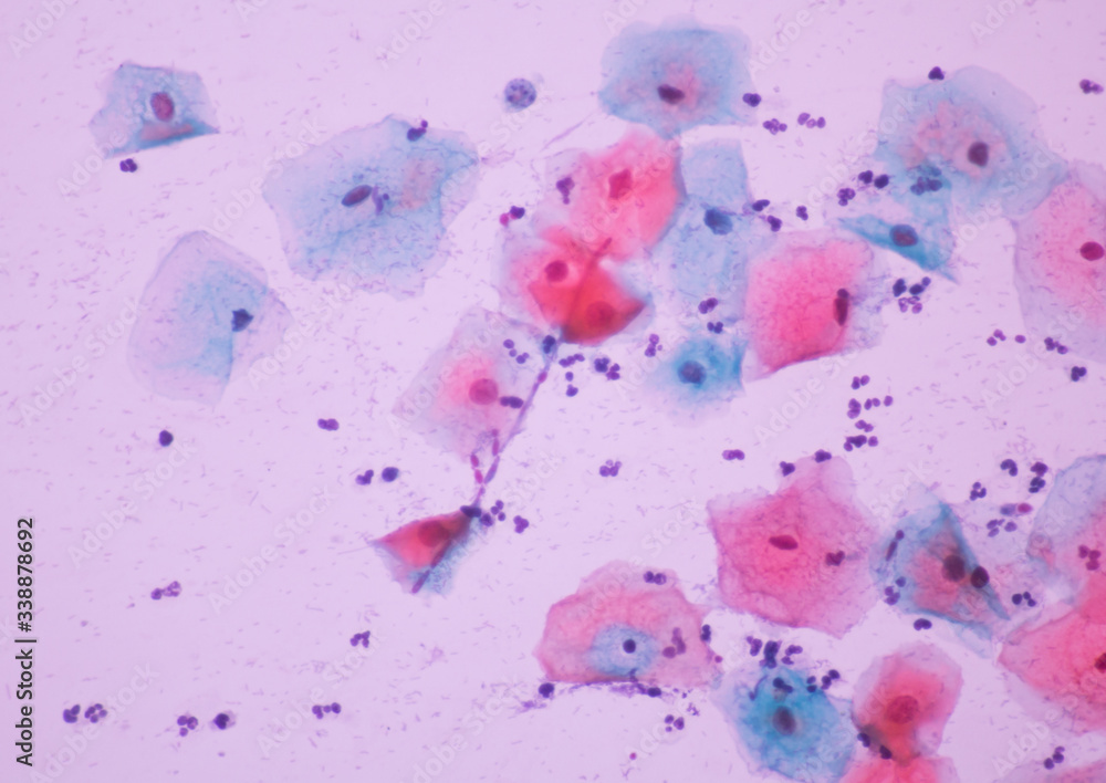 View in microscopic of Candidiasis, fungus infection (Yeast and ...