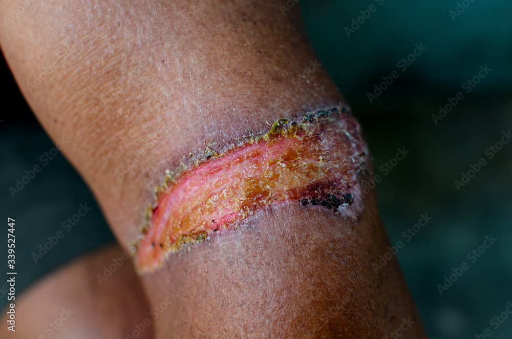 Severe Scab wound infected in skin on man arm close up.Health care ...
