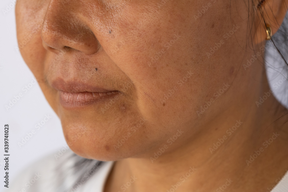 Foto de Stock An Asian woman with the Nasolabial folds (cheeks lines ...