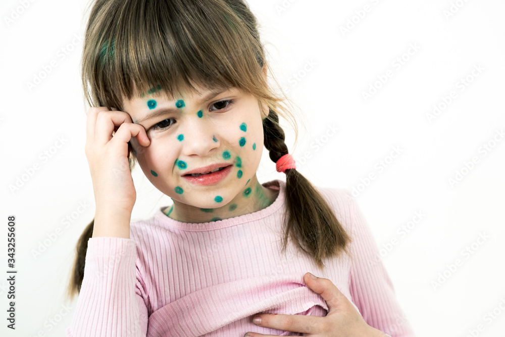 Child girl covered with green rashes on face ill with chickenpox ...