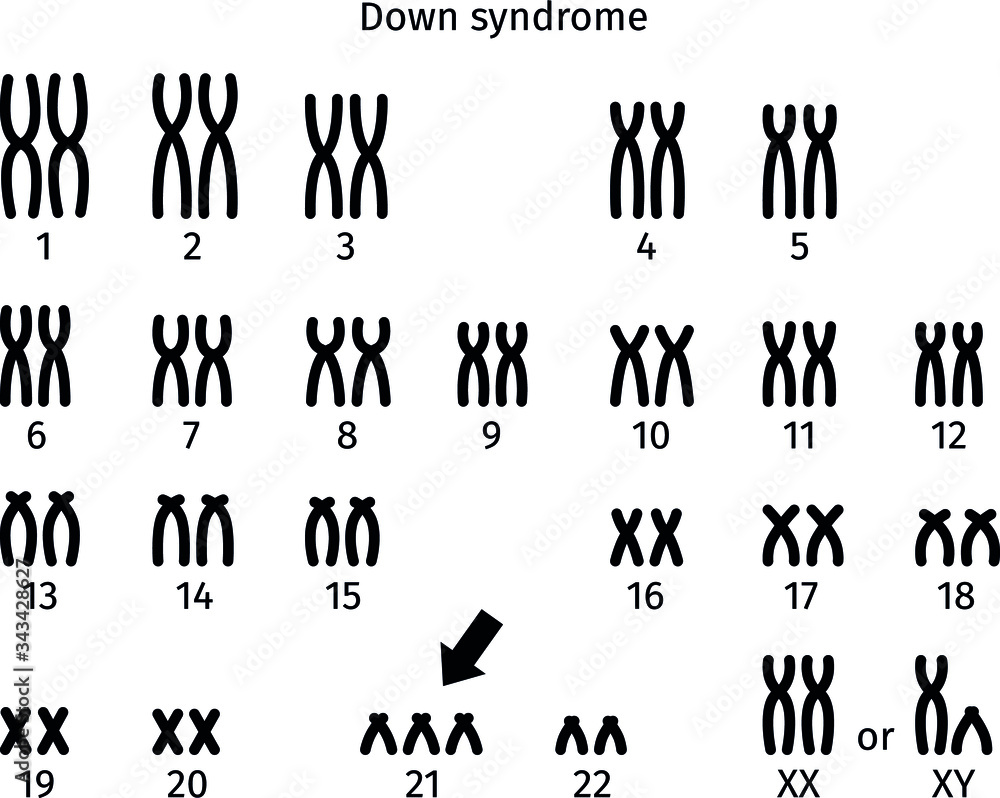 Scheme of Down syndrome karyotype of human somatic cell 47XX+21 and ...