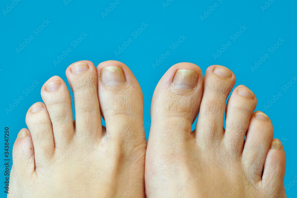 female feet foot legs. toes with nail psoriasis. A woman has ingrown ...