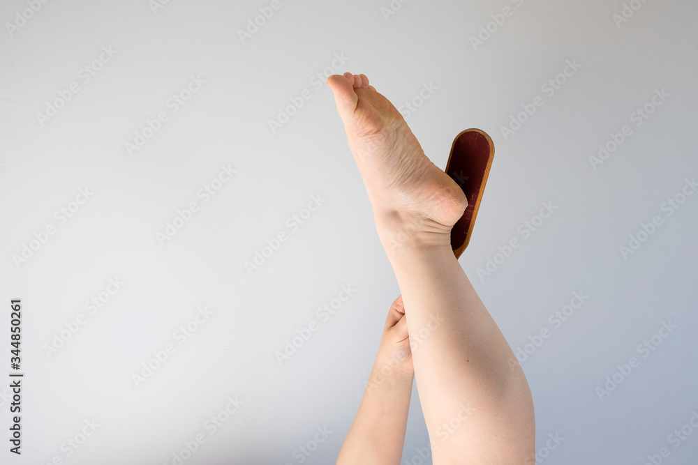 foot with rough skin and a dry heel with many cracks. The concept of ...