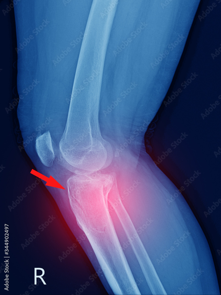X-ray knee Fracture proximal metaphysis of tibia.Depressed fracture of lateral tibial plateau ...