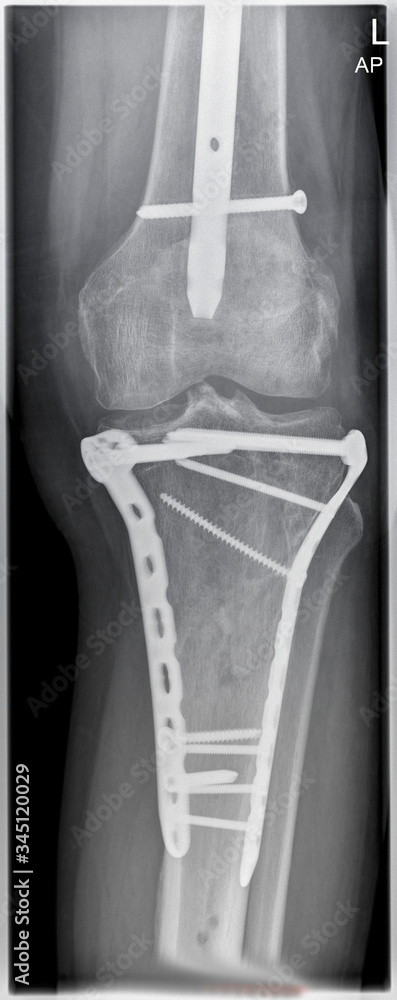 Radiographs, x-rays of a heavily injured motorcyclist with multiple ...