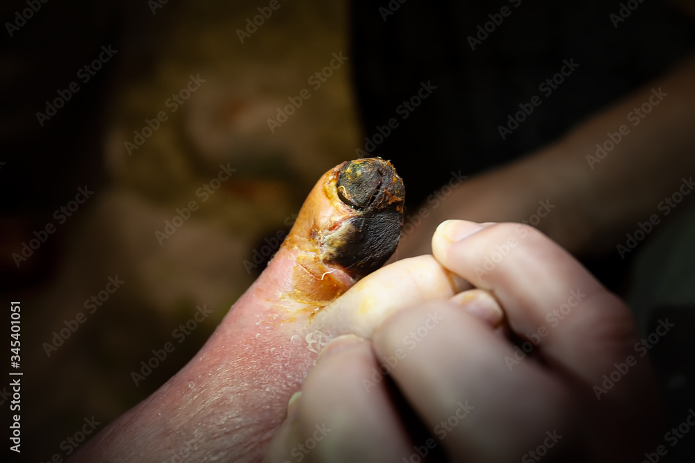 Gangrene of the toe of an old grandmother. Nail blackening, tissue ...