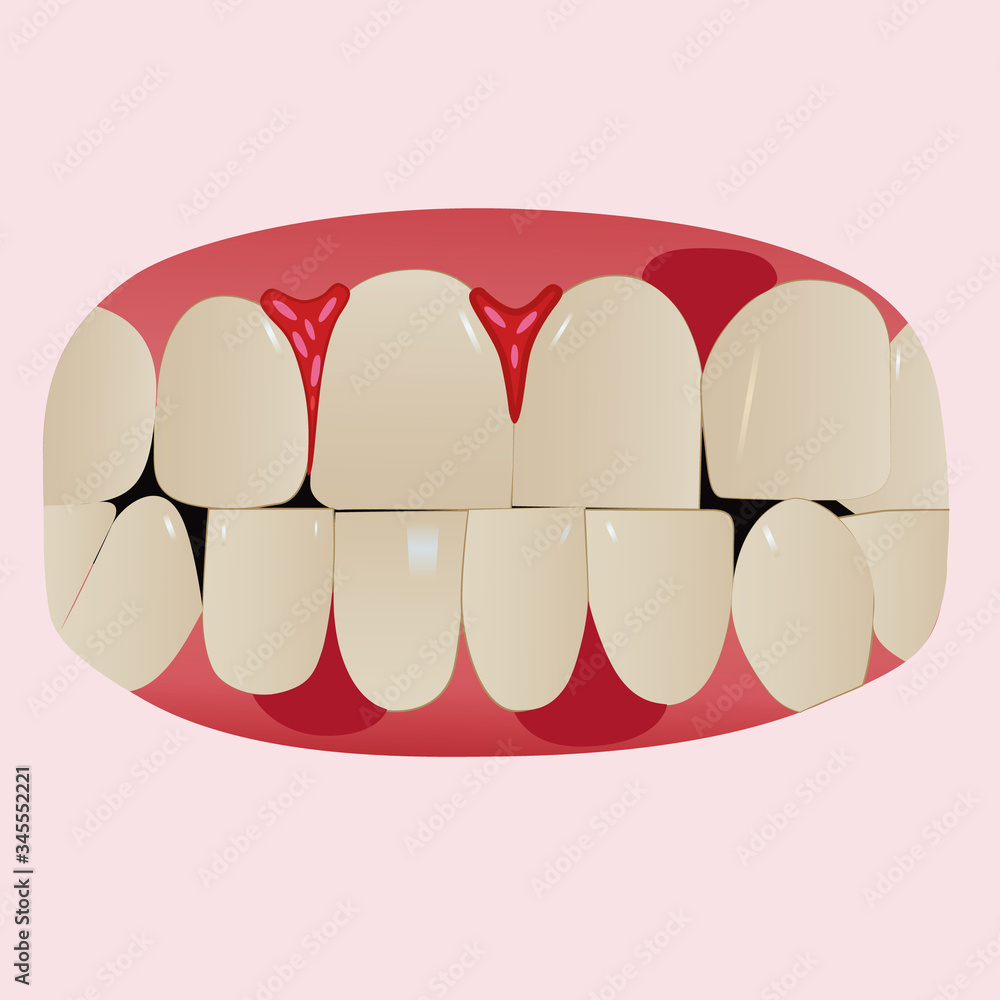 A teeth vector related to gingivitis disease. Hand-drawn bleeding gums ...