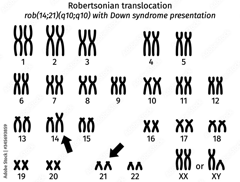Vector de Stock Scheme of Robertsonian thanslocation with clinical ...