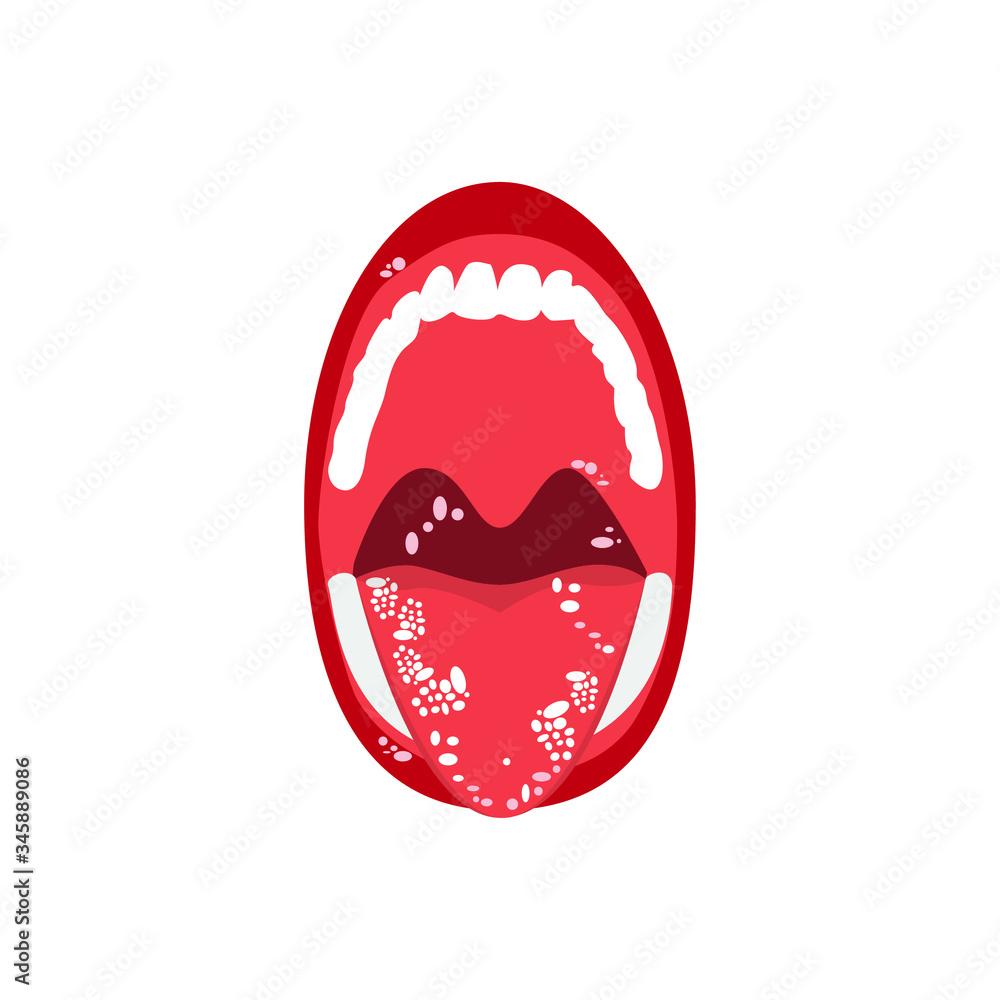 open mouth with ulcers, pus, stomatitis, tongue, cold sores on the lips ...