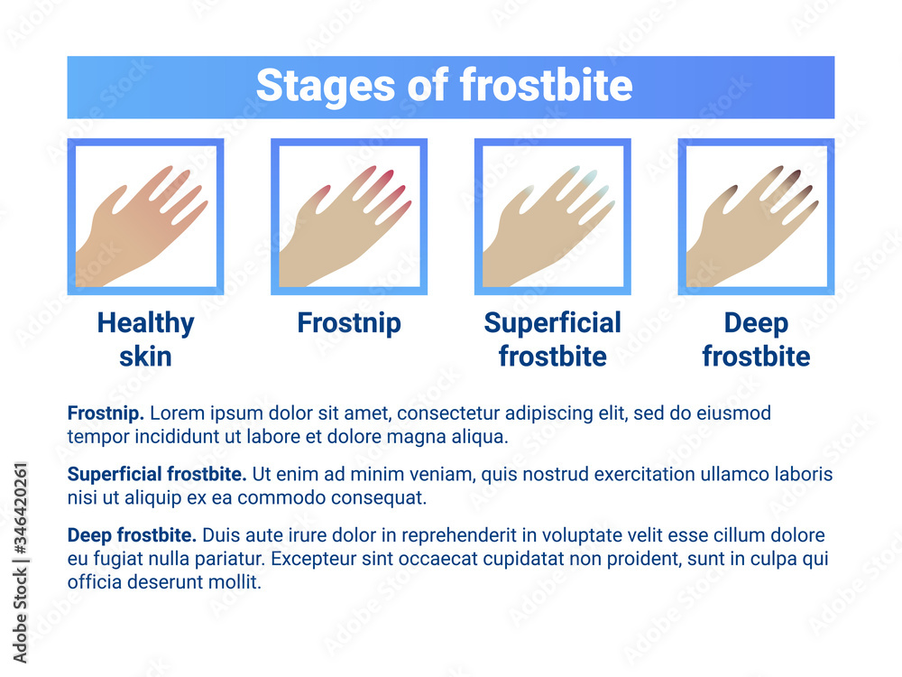 Vector de Stock Avoiding frostbite banner with visual symptoms of hands ...