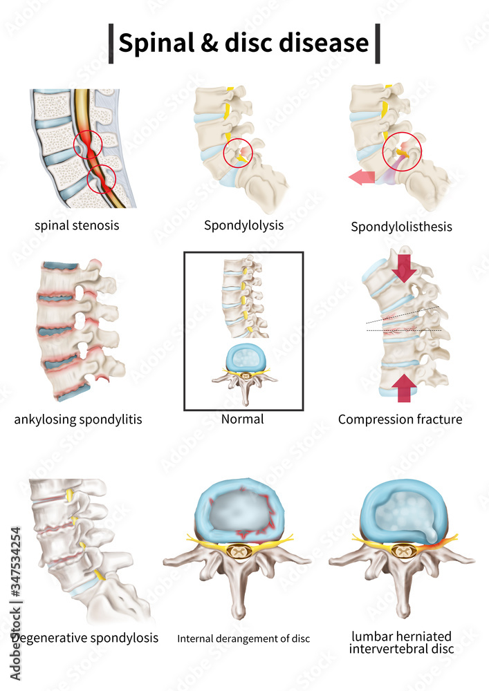 Spinal & disc disease medical illust 素材庫插圖 | Adobe Stock