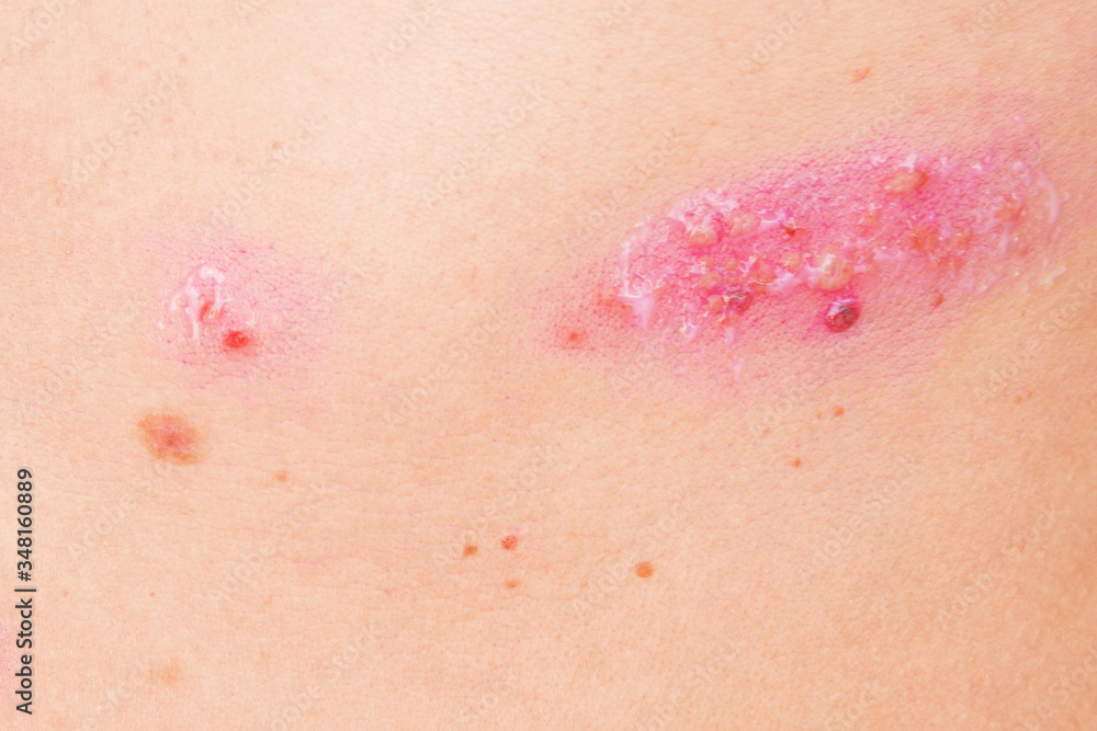 skin rash treatment on woman body. Shingles, Disease, Herpes zoster ...