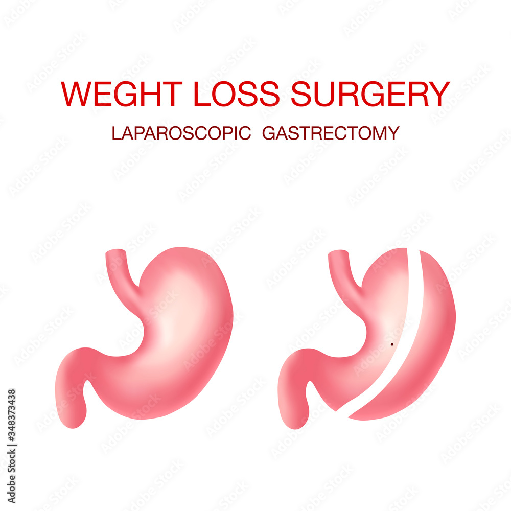 Vertical Sleeve Gastrectomy medical vector illustration diagram with ...
