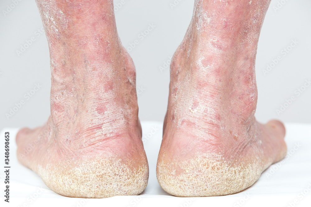 Acute psoriasis on male legs and heels is an autoimmune incurable ...