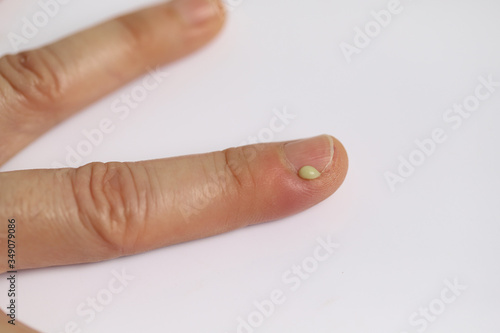 Finger swollen with inflammation due to Nail ripped infection, Finger ...