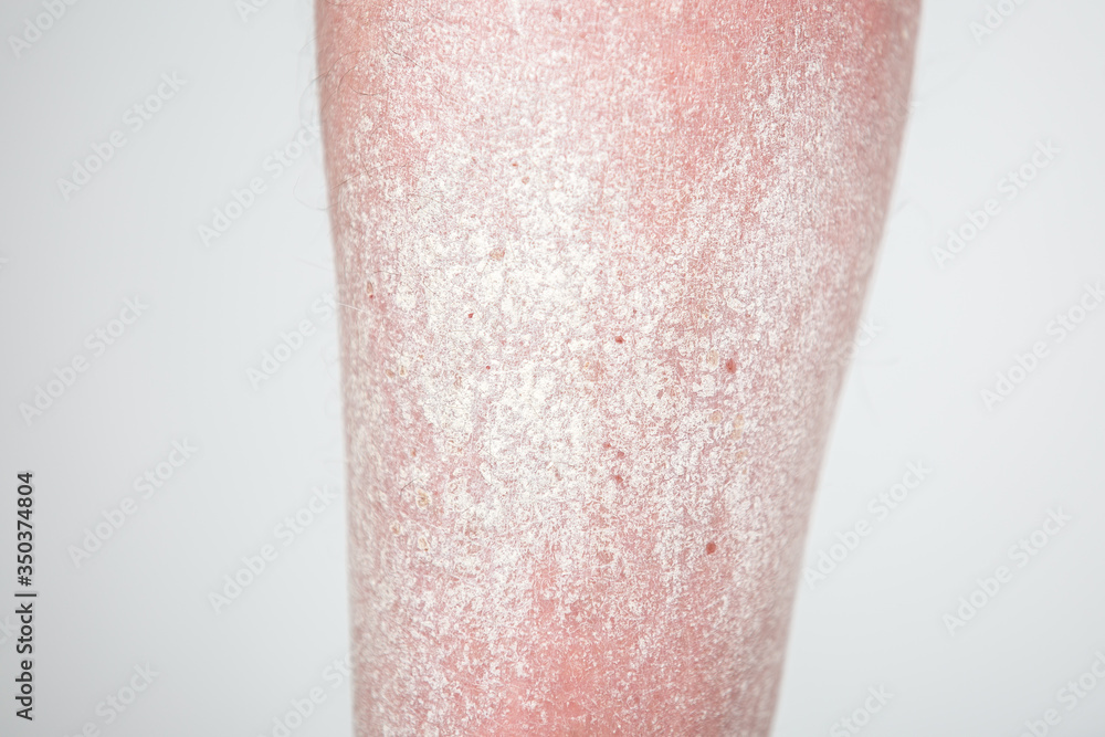 Acute psoriasis on male legs and heels is an autoimmune incurable ...