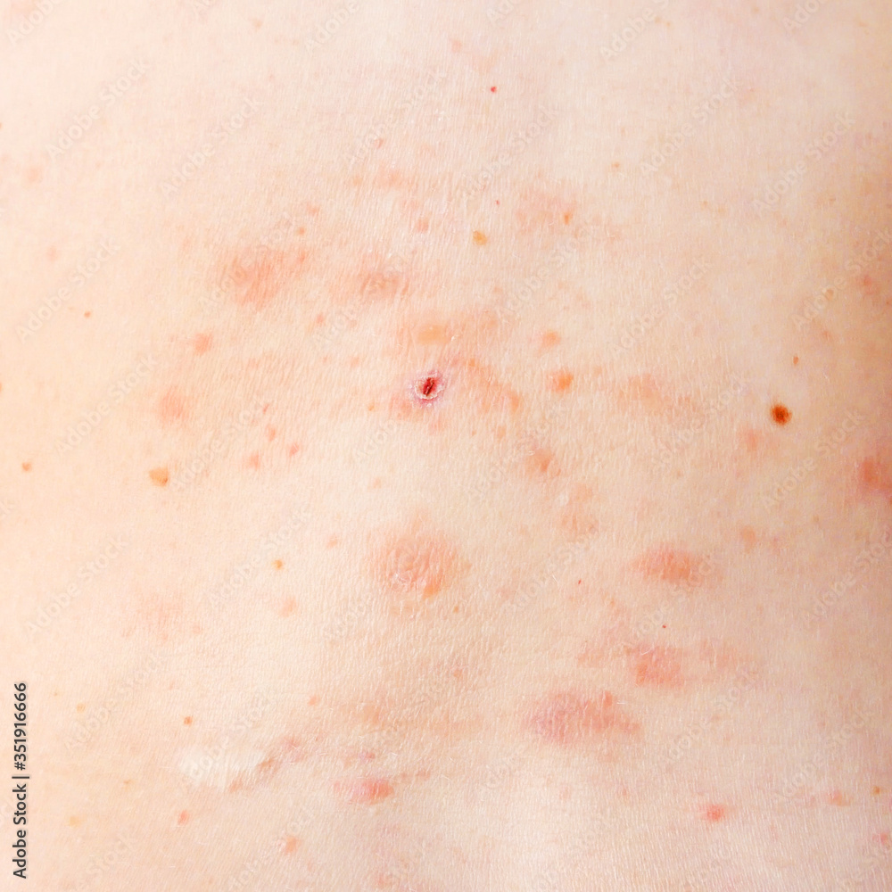skin rash treatment on woman body. Shingles, Disease, Herpes zoster, varicella-zoster virus ...