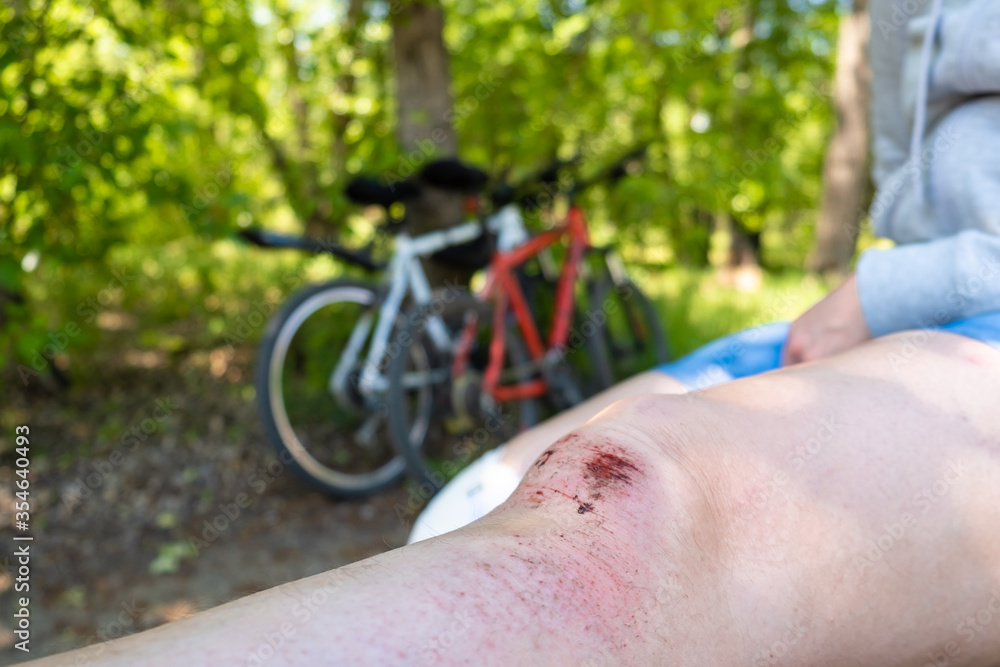 Damage to the legs during outdoor activities in the summer, cycling. An ...