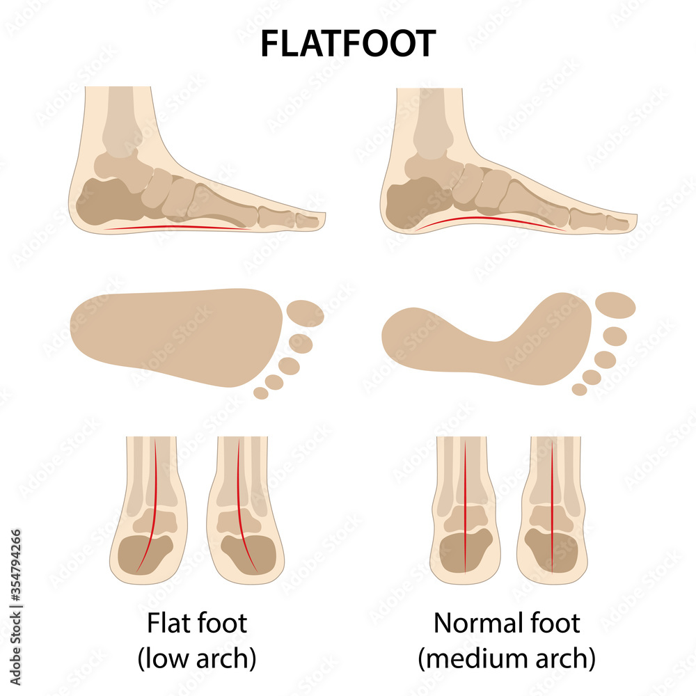 Orthopedics. Flatfoot. Difference between sick and healthy feet. Side ...